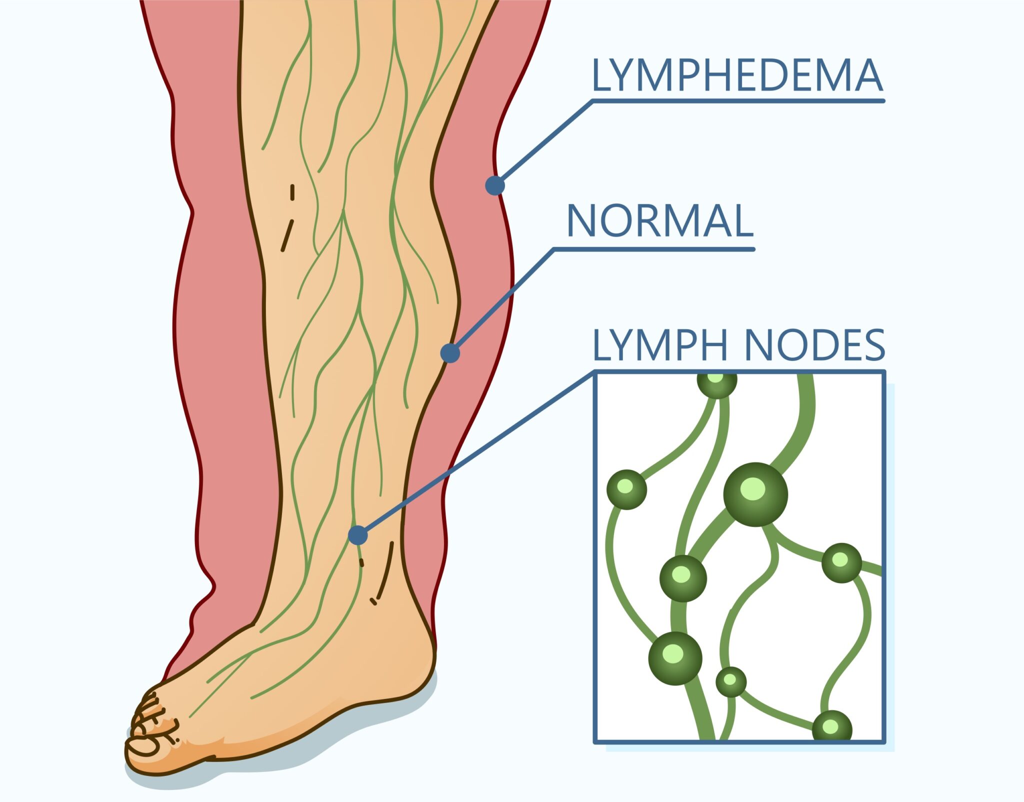 Lymphoedema Clinic | Lymphoedema Practitioner